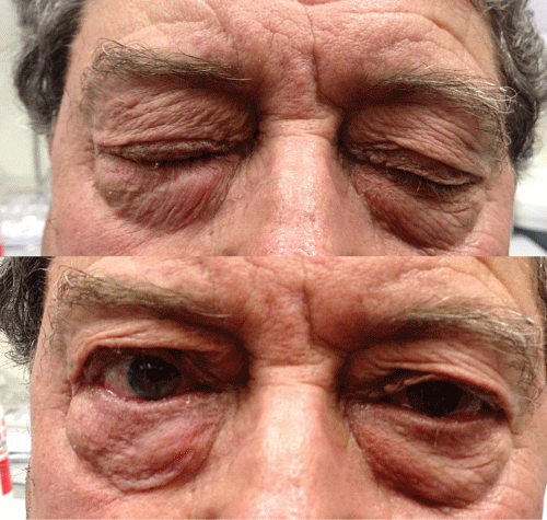 Surgical Management of Concomitant Ptosis and Cicatricial Entropion in ...