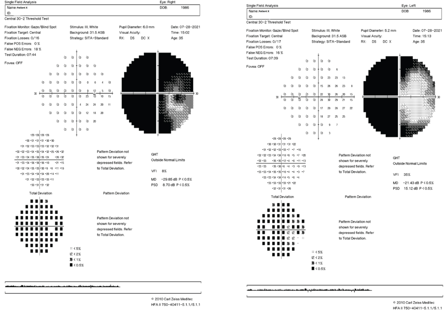 An Investigative Report On The Neuro Optometric Manifestation Of SARS